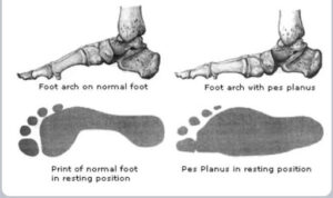 Impact of Flat Foot on Hip & Knee Pain | Spectrum Physio